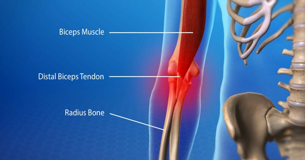 Physical Therapy for Bicep Tendonitis: Techniques & Benefits