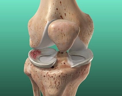 Torn Cartilage in the Knee: Treatment and Preventive Measures