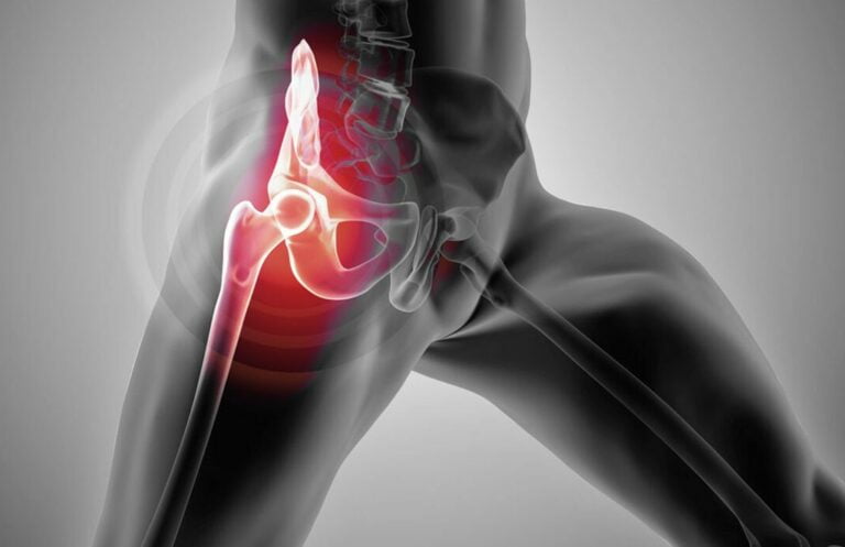 Bone Spurs In Hip: Symptoms To Know, Treatment And Tips