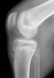 Osgood Schlatter Disease: Signs, Causes and Treatment Methods