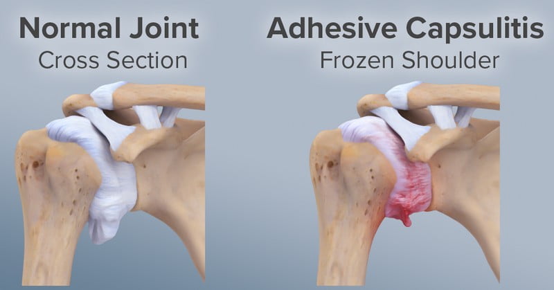 Shoulder Problems: Common Problems And Tips To Prevent