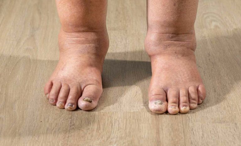 Physical Therapy for Complex Regional Pain Syndrome